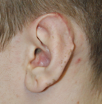 Ear Plastic Surgery | Otoplasty Before & After Photos Seattle Bellevue