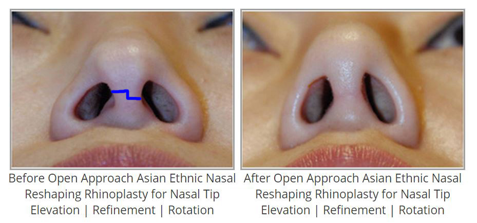 Rhinoplasty Open Versus Closed Approaches by Seattle & Bellevue