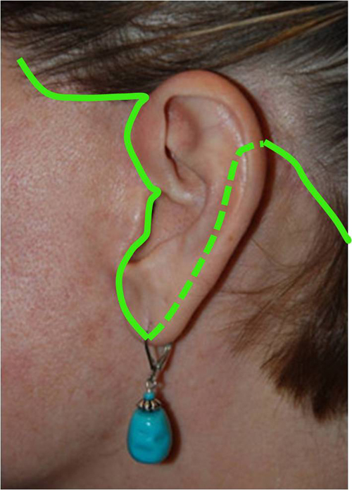 Neck Contouring with Fat Injections Seattle Bellevue